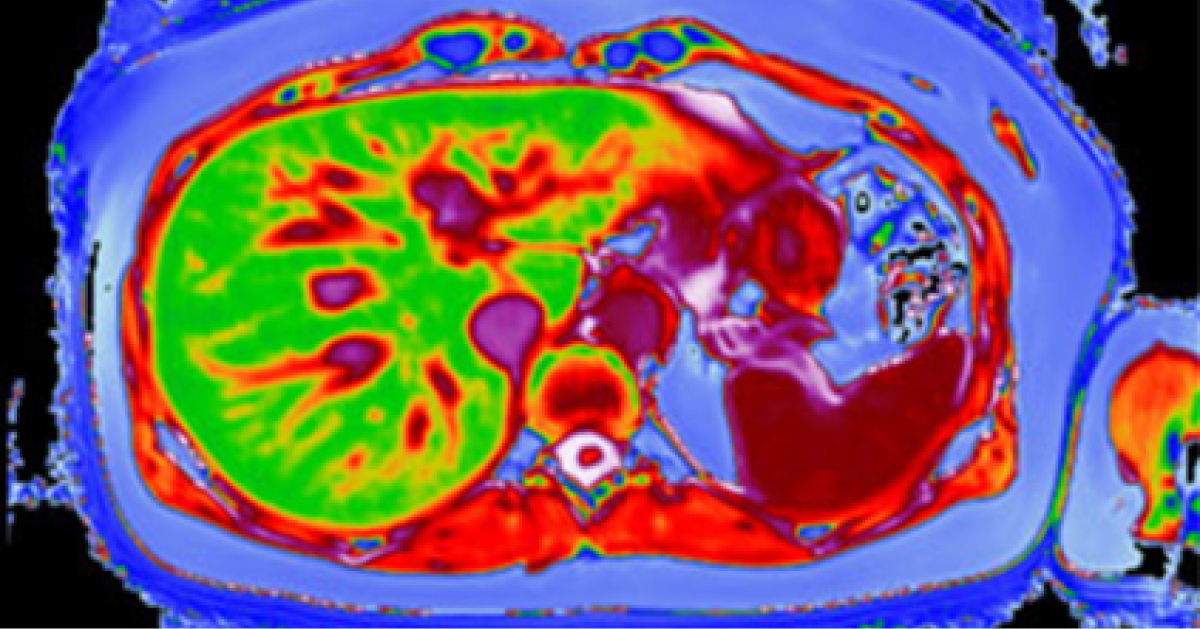 Large population imaging study reveals utility of LiverMultiScan’s cT1 ...